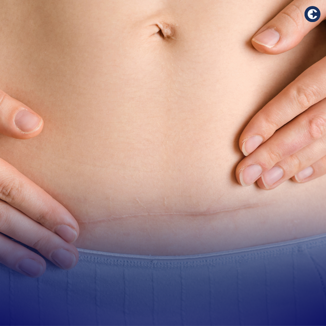 The Controversial Costs Of Cesarean Sections: A Look At Insurance ...